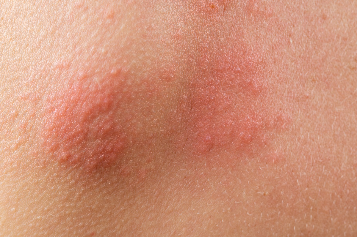 Effective Tips for Managing Shingles