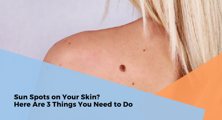 Sun Spots on Your Skin: 3 Things You Need to Do - NonCount.com