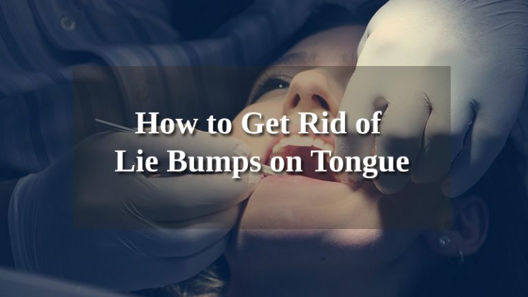 How to Get Rid of Lie Bumps on Tongue